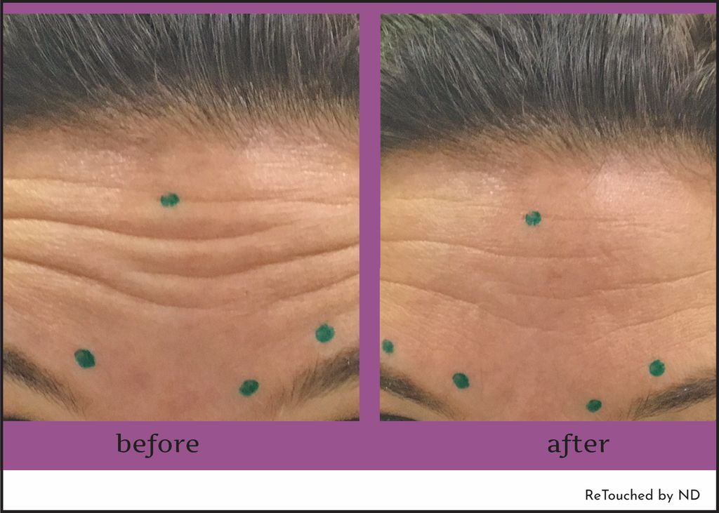 Things you need to know about Botox explained by Dr Naomi Dolly ...